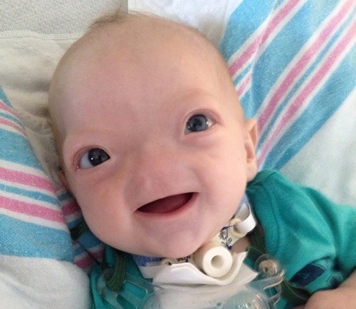 Baby Born Without A Nose - Read His Story Here! - theAsianParent
