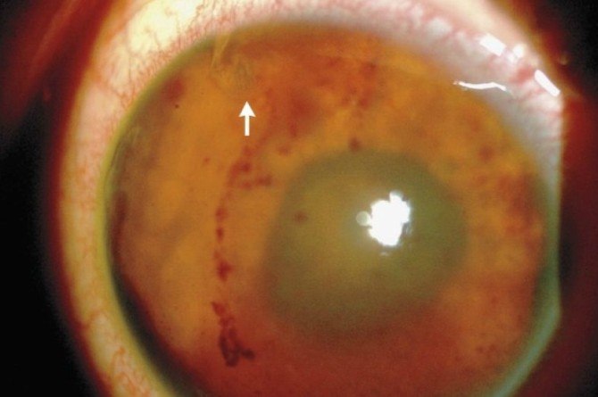 Parasitic worms found in teenager's eye, damaging his eyesight