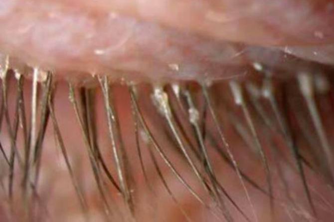 Eye Parasites: Over 100 Caused This Woman's Eye Itching And Redness