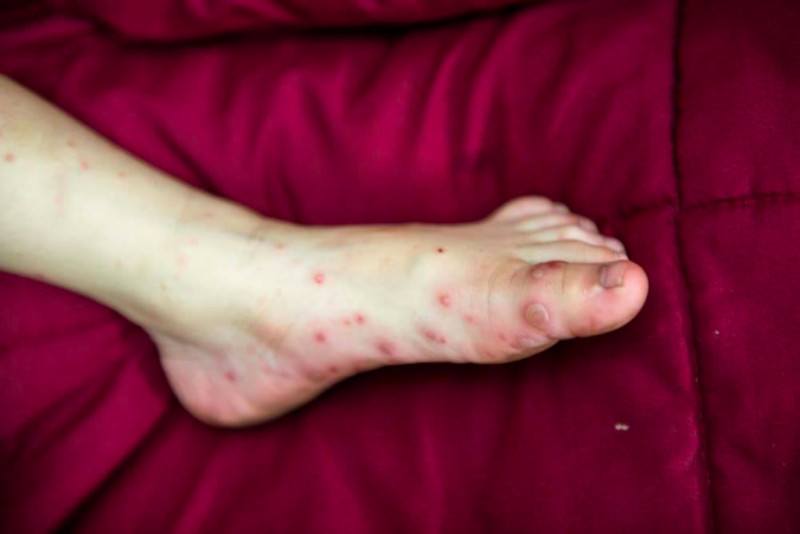 Sintomas Ng HFMD (Hand Foot Mouth Disease) At Gamot Para Rito