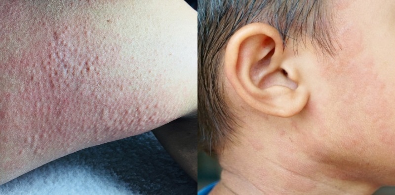 Cold Urticaria: Ang Skin Allergy Na Lumalabas Kapag Nilalamig Ang Tao