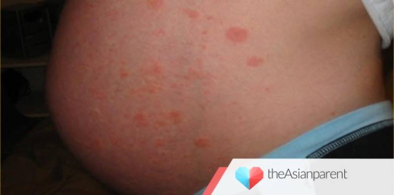 Polymorphic Eruption Of Pregnancy Treatment: Belly Rash In Pregnancy