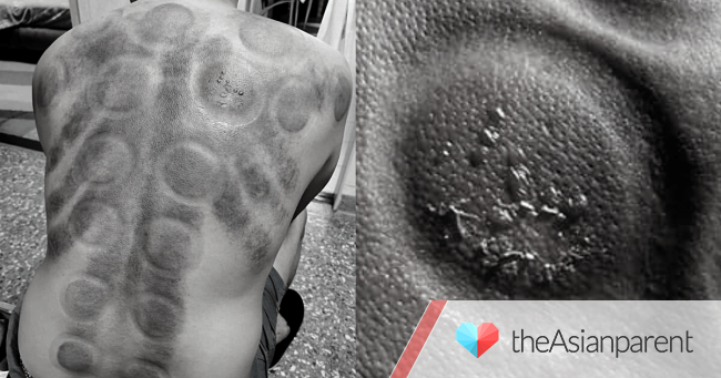 Cupping Therapy Leaves Singapore Man With Severe Burns And Blisters