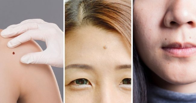 Lucky Moles On Your Face And The Rest Of Your Body