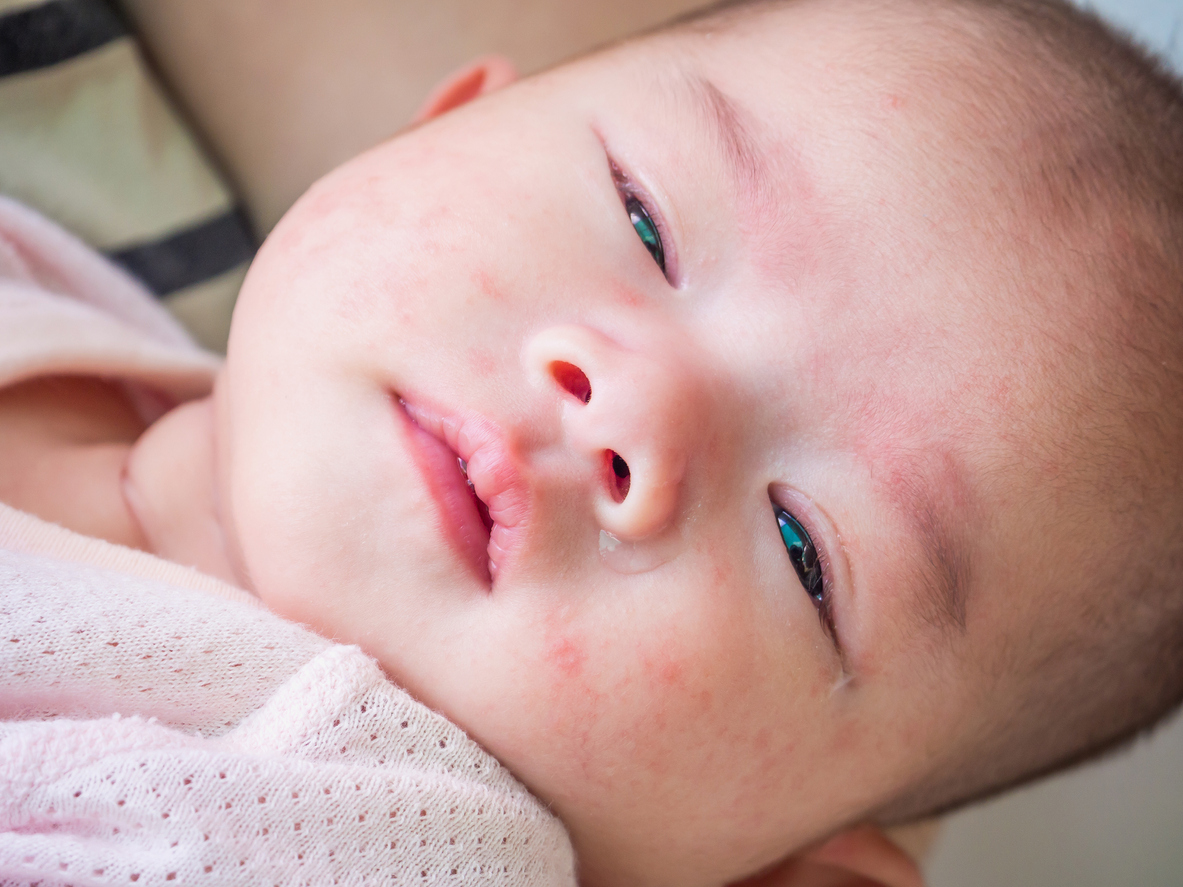 7 Possible Cause of Baby's Skin Rashes and Home Remedies to Try