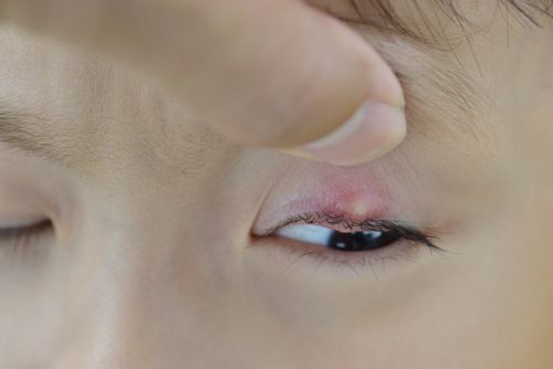 Bintitan pada Anak, Haruskah Anda Merasa Khawatir?