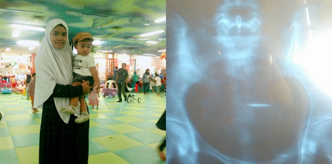 KB IUD Berpindah Tempat, Ibu ini Jalani Prosedur yang Menyakitkan