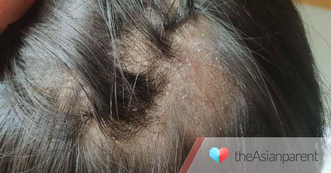 Tinea capitis, infeksi jamur di kulit kepala anak yang sangat menular