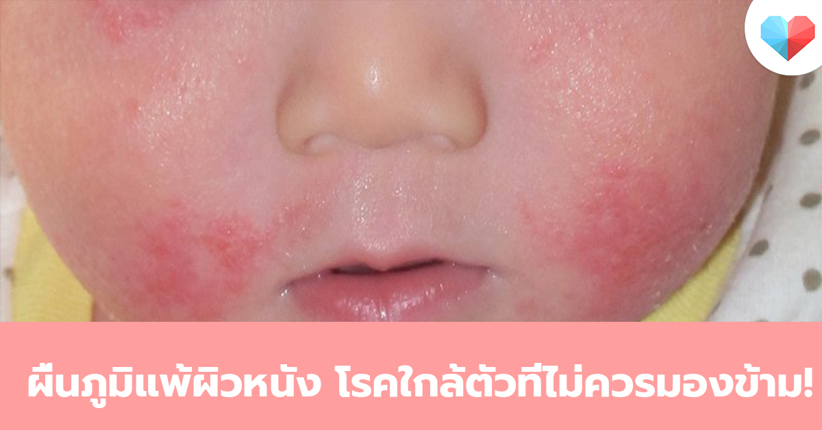 ผื่นภูมิแพ้ผิวหนัง โรคใกล้ตัวที่ไม่ควรมองข้าม - The Asianparent