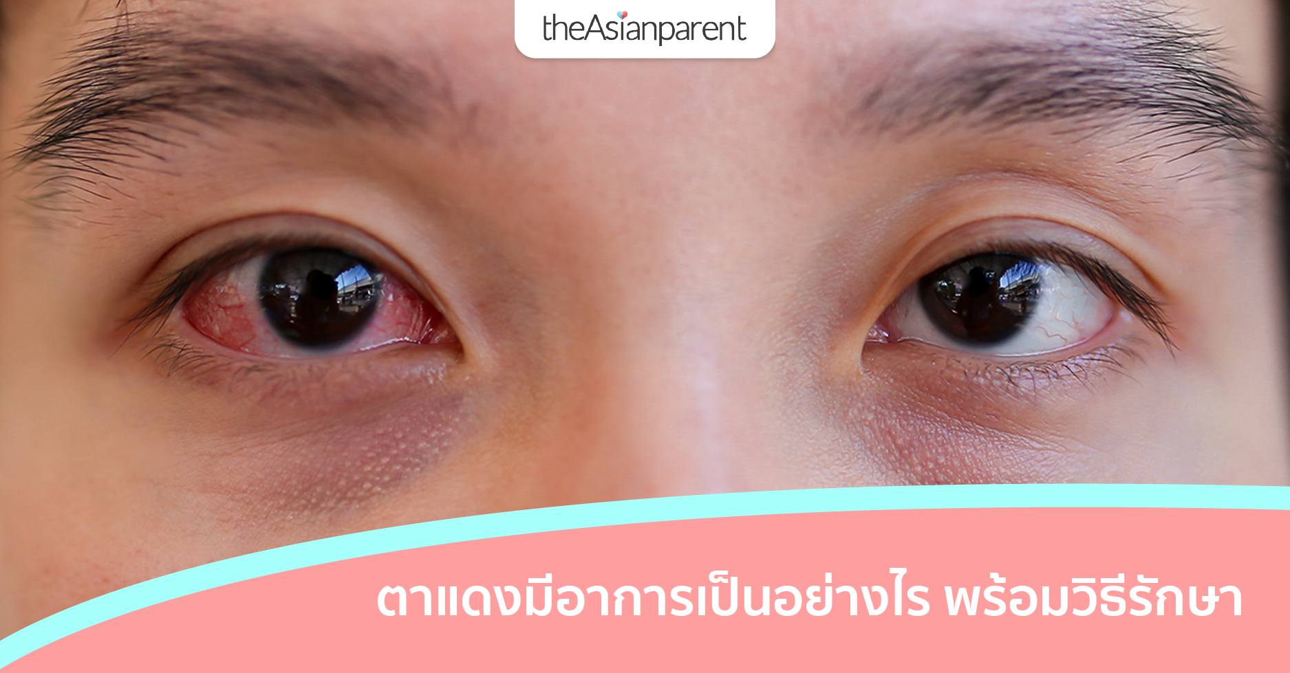 ตาแดง คืออะไร โรคตาแดงมีอาการเป็นอย่างไร มีวิธีรักษาอาการตาแดงอย่างไรบ้าง