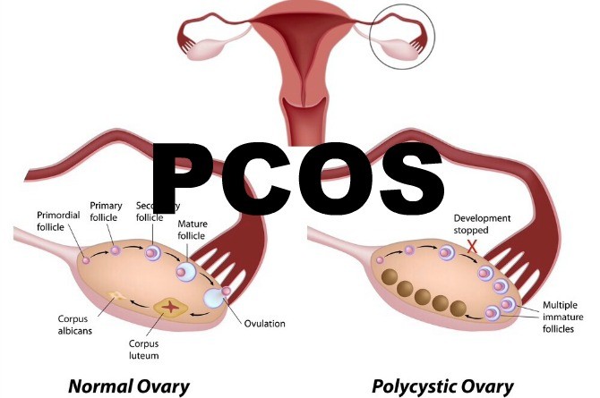 Pcos Simptom & Semua Yang Anda Perlu Tahu Tentangnya