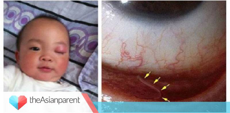 Cacing Dalam Mata Anak Sebab Tak Basuh Tangan Lepas Keluar Tandas